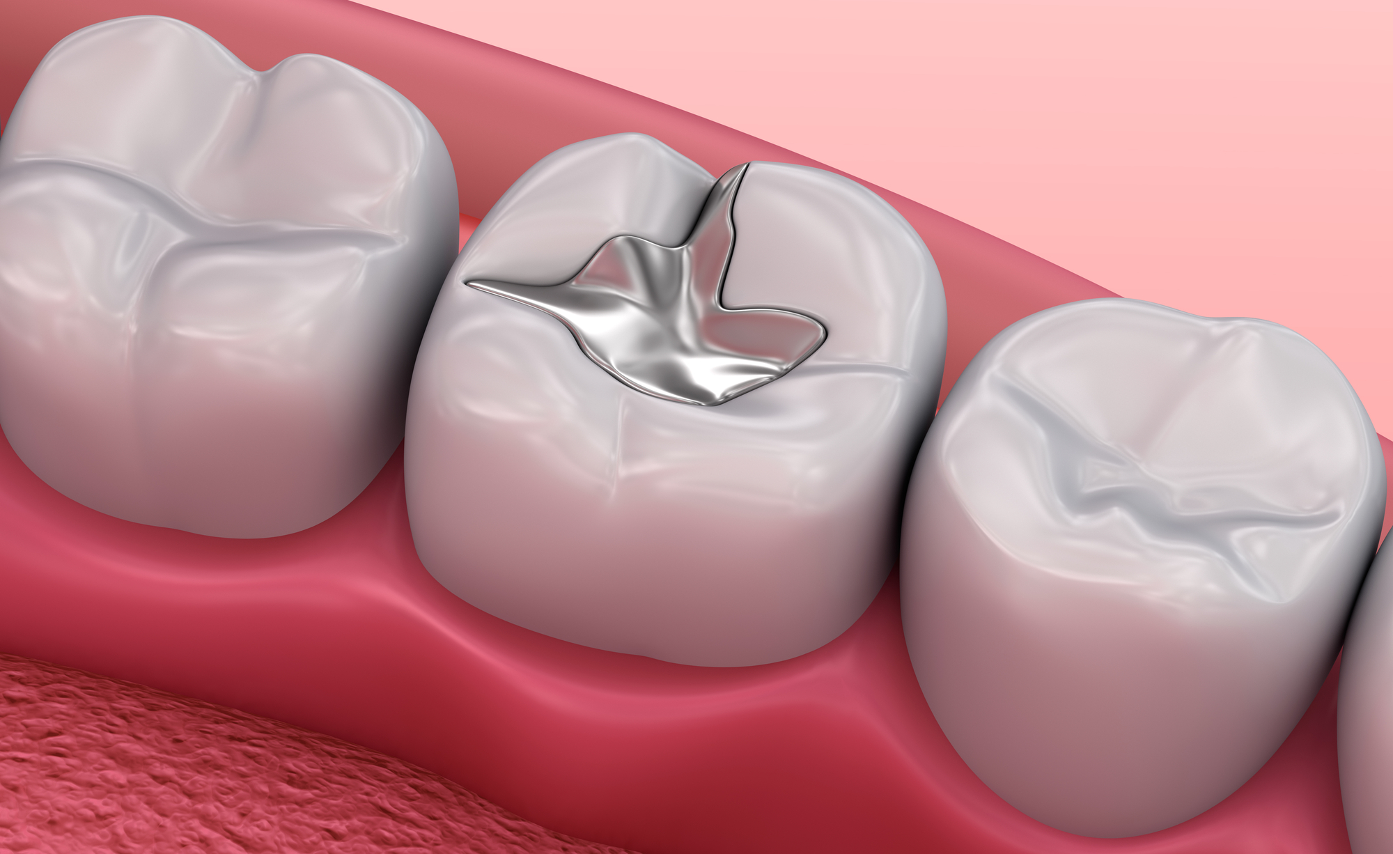 Dental Fillings and Sensitivity: Tips for Soothing Tooth PainDental News